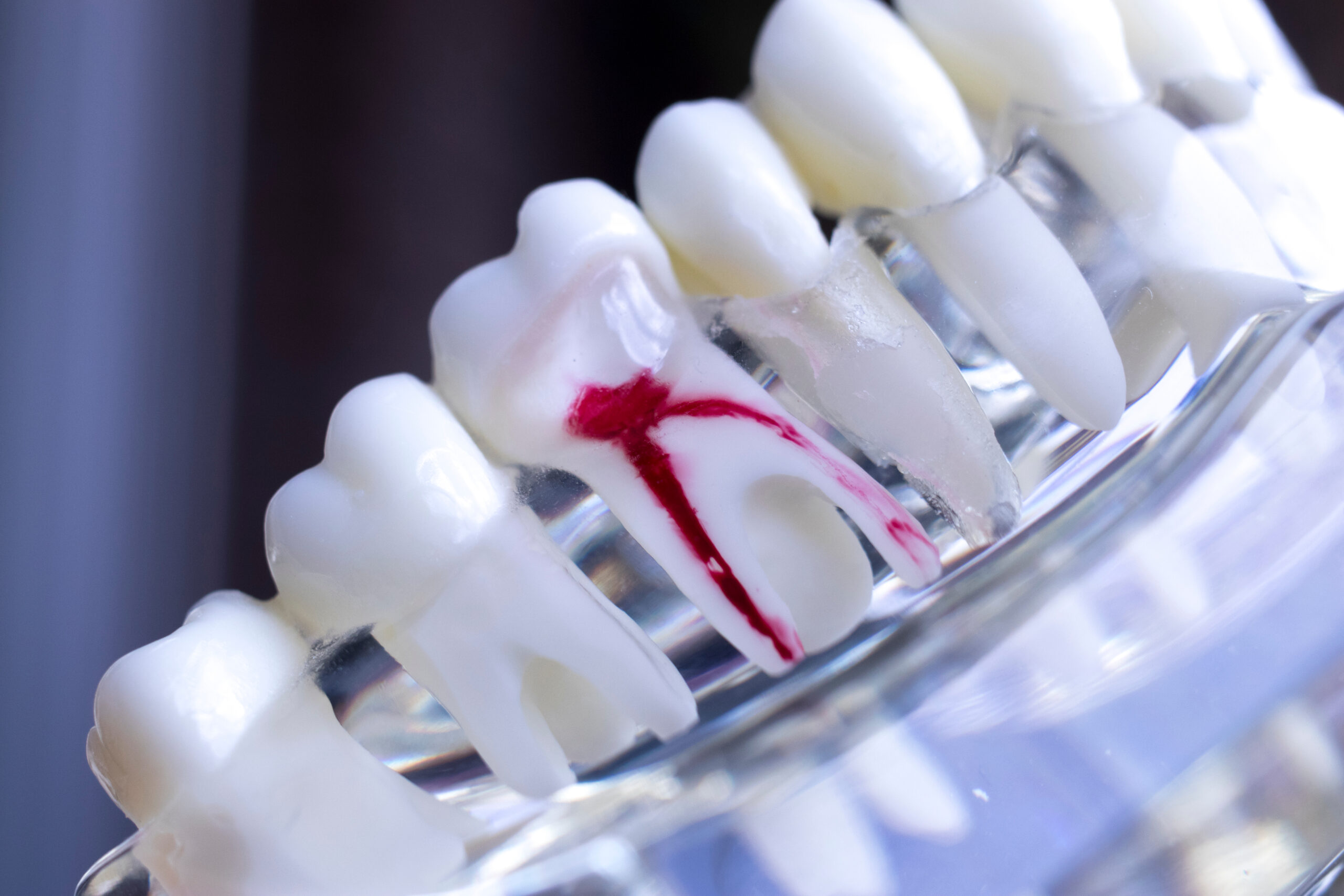 Top 3 Reasons You May Need a Root Canal - Torbram Dental